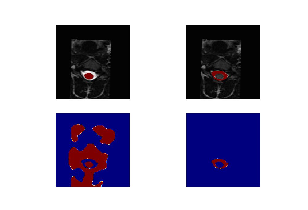 Multiclass Segmentation Diceloss Vs Multiclassloss · Issue 320 · Ivadomed Ivadomed · Github