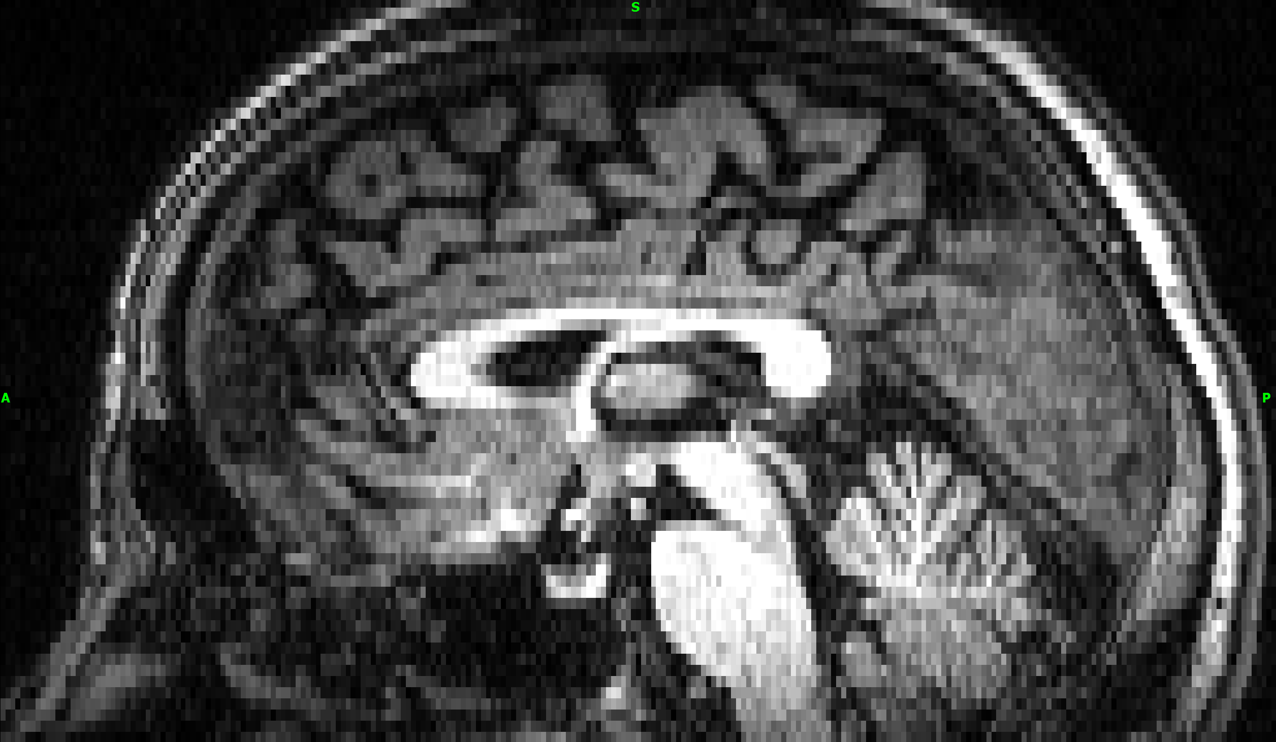 new method for defacing MRI (3D and 4D volume) · Issue #307 ...