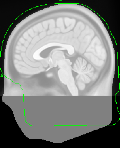 new method for defacing MRI (3D and 4D volume) · Issue #307 ...