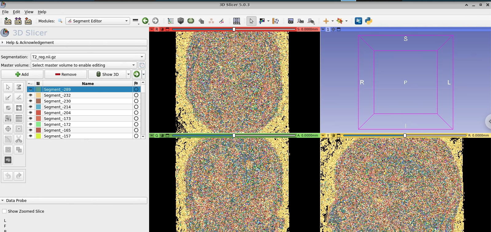wrong CHARM segmentation · Issue #93 · simnibs/simnibs · GitHub wrong CHARM segmentation · Issue #93 · simnibs/simnibs · GitHub