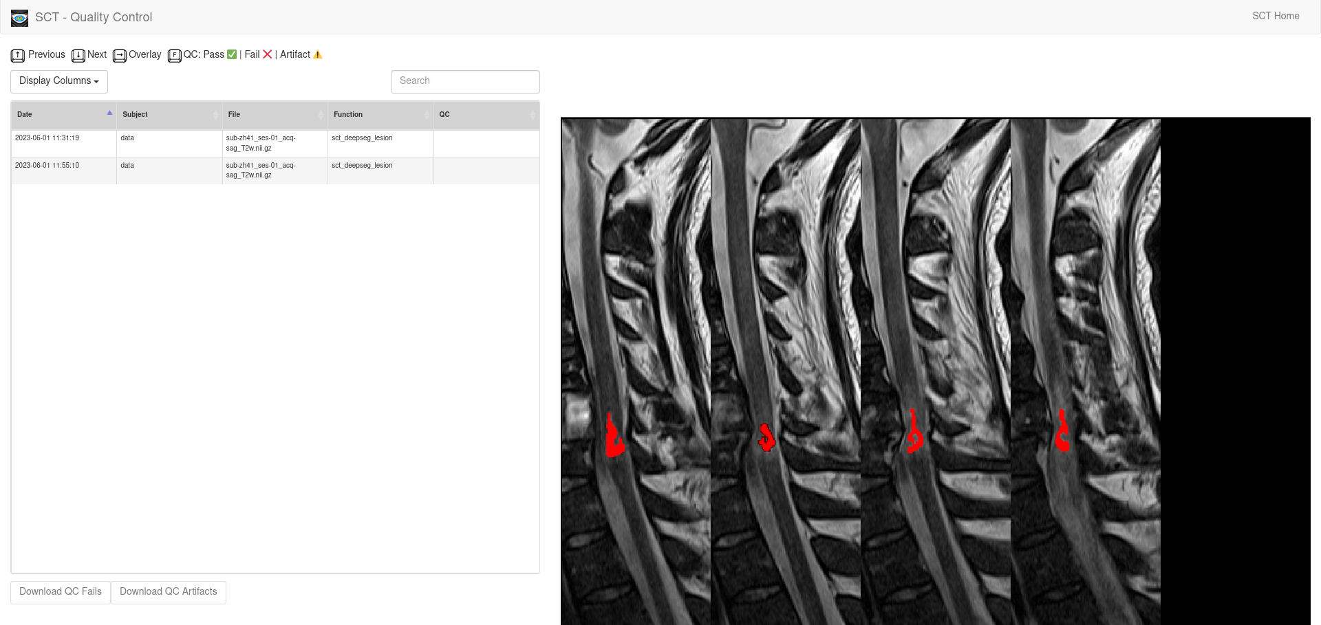 Default resampling (`0.6mm`) for `sct_deepseg_lesion` QC report distorts lesion softsegs · Issue ...