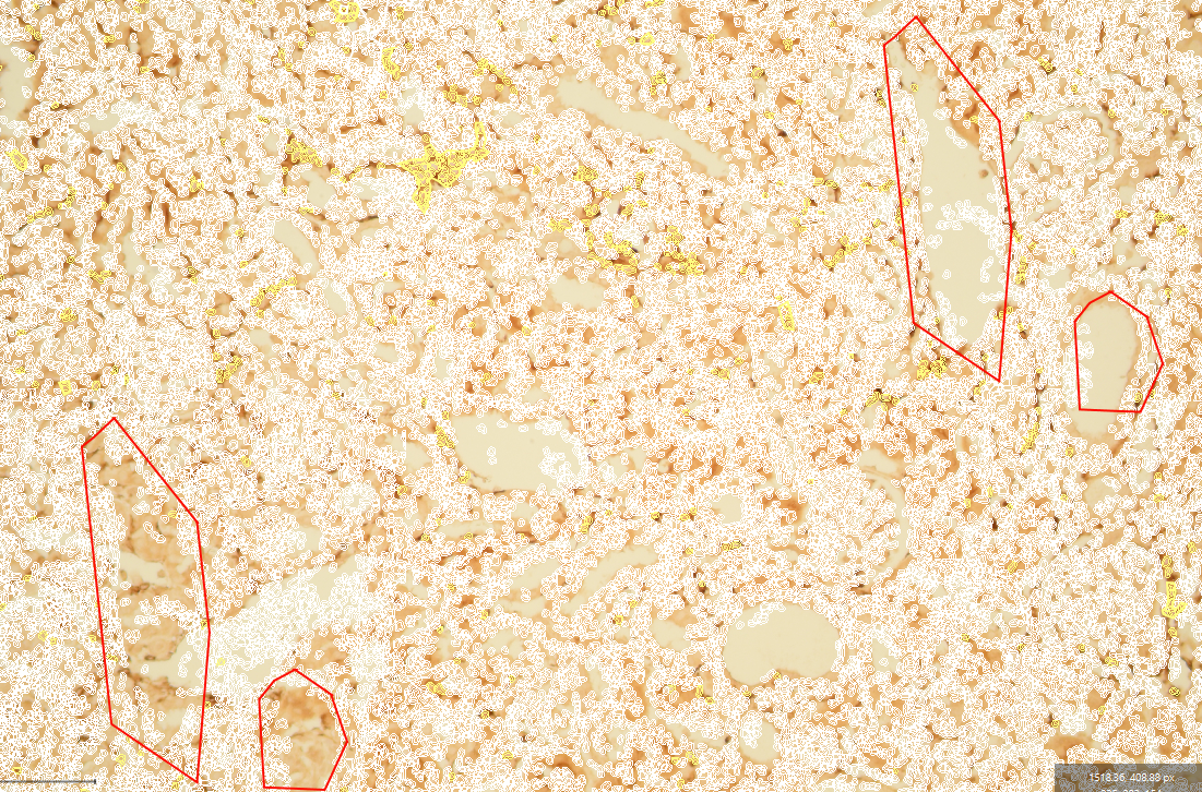 severe cell detection error - hard to reproduce · Issue #153 · qupath/qupath · GitHub