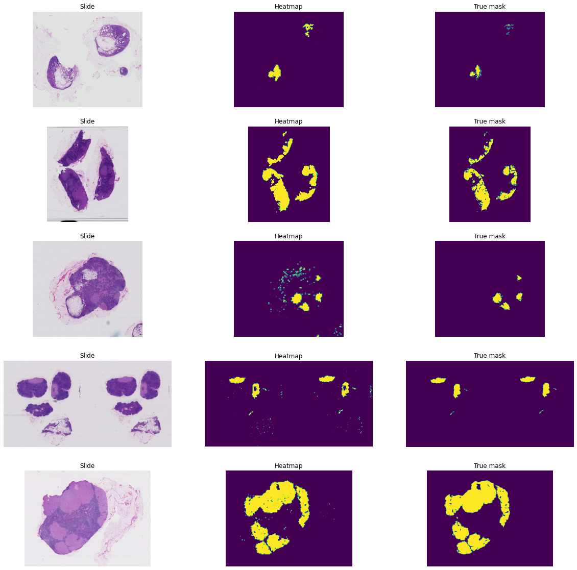 GitHub - maulik96/tumor-detection: Detecting Cancer Metastases on ...