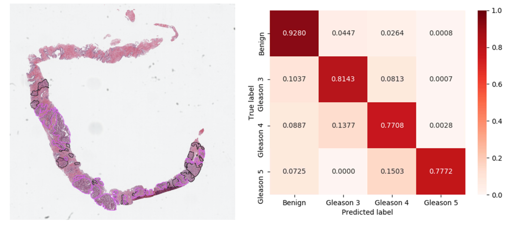 Github Akaragou Gleason Deep Learning For Pathology