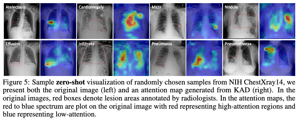 About the attention map · Issue #3 · xiaoman-zhang/KAD · GitHub
