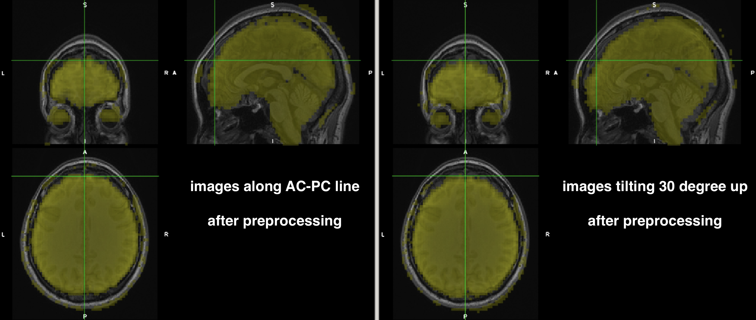 Failed Normalization of BOLD · Issue #2410 · nipreps/fmriprep · GitHub