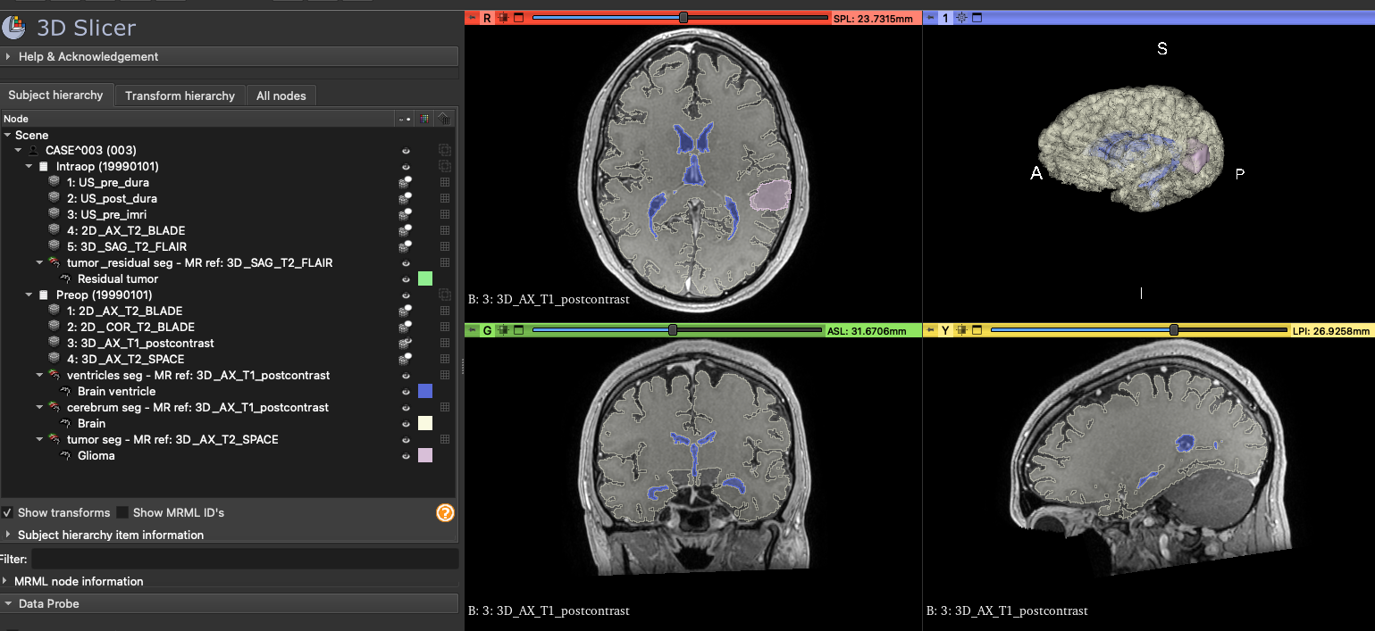GitHub - ReubenDo/ReMIND: Scripts used for the conversion of the NRRD data to DICOM data