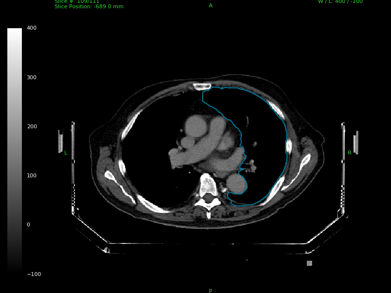 Only one contour per slice · Issue #465 · pytrip/pytrip · GitHub