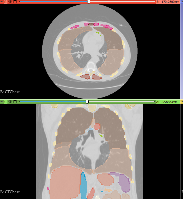 Hole in the segmentation v2 · Issue #194 · wasserth/TotalSegmentator · GitHub