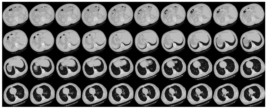 GitHub - anurag19997/3D-Image-classification-of-CT-scans