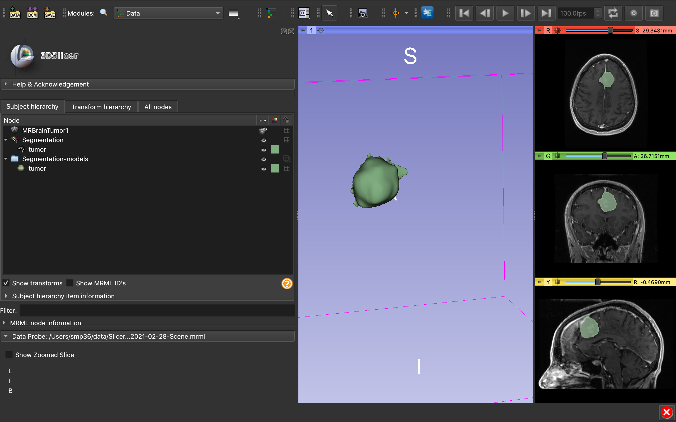 Markups Module shows all subject hierarchy folders · Issue #5493 · Slicer/Slicer · GitHub