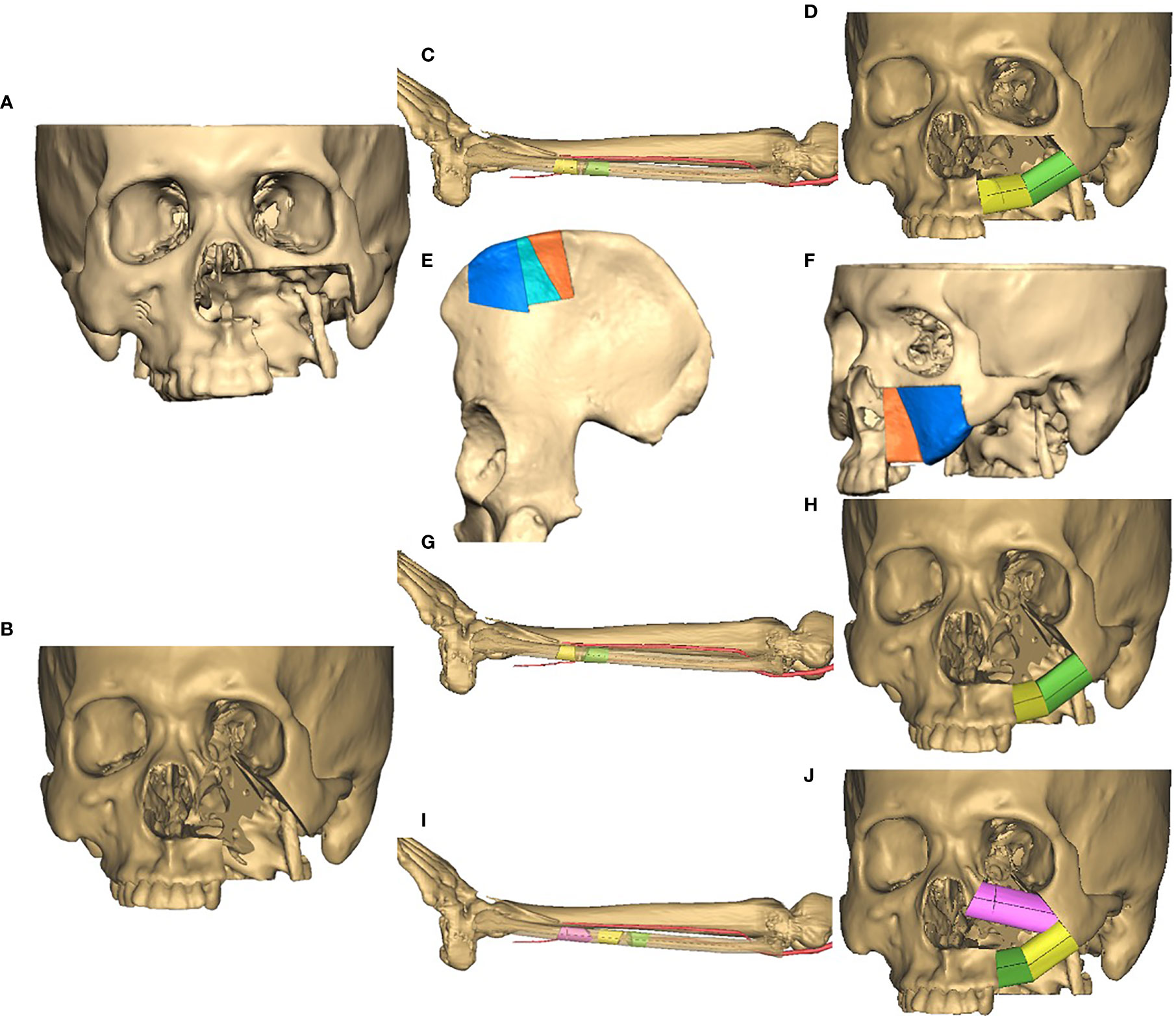 Allow maxillary reconstruction with fibula on a new module · Issue #77 ...