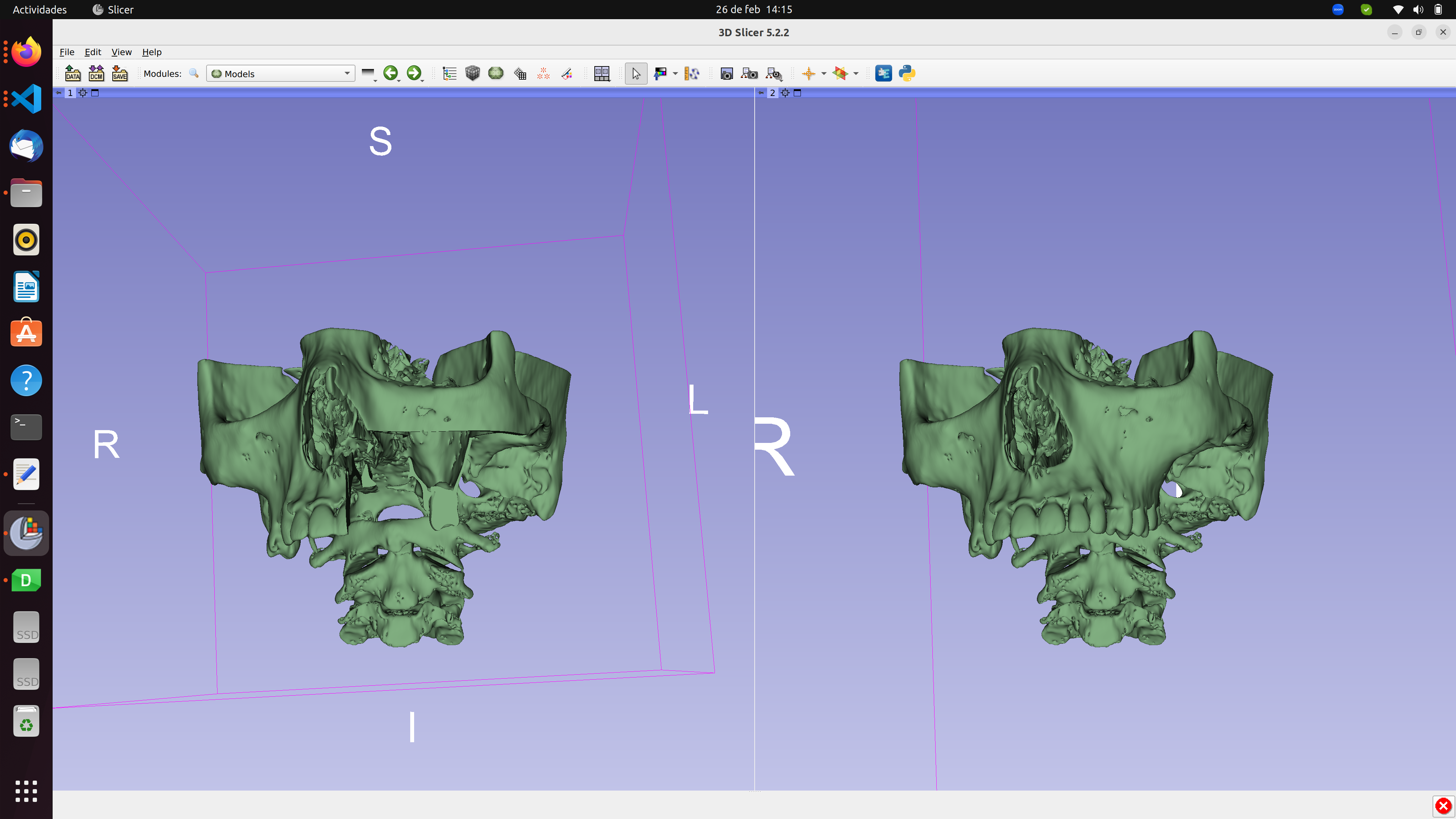Allow maxillary reconstruction with fibula on a new module · Issue #77 ...