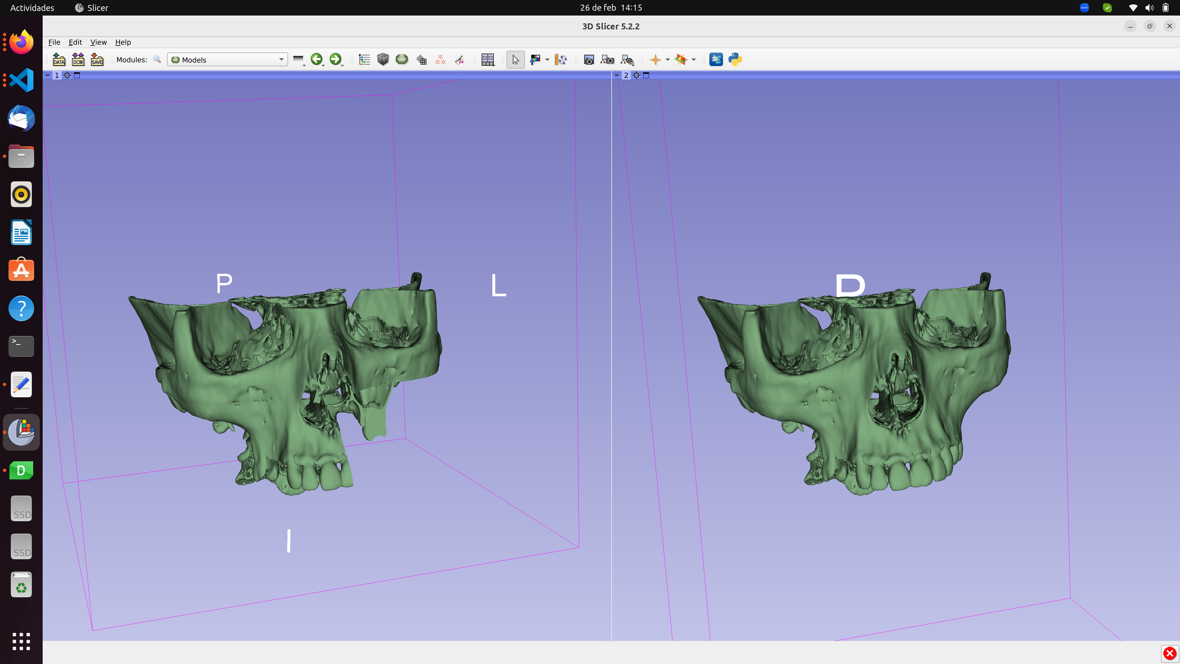 Allow maxillary reconstruction with fibula on a new module · Issue #77 ...