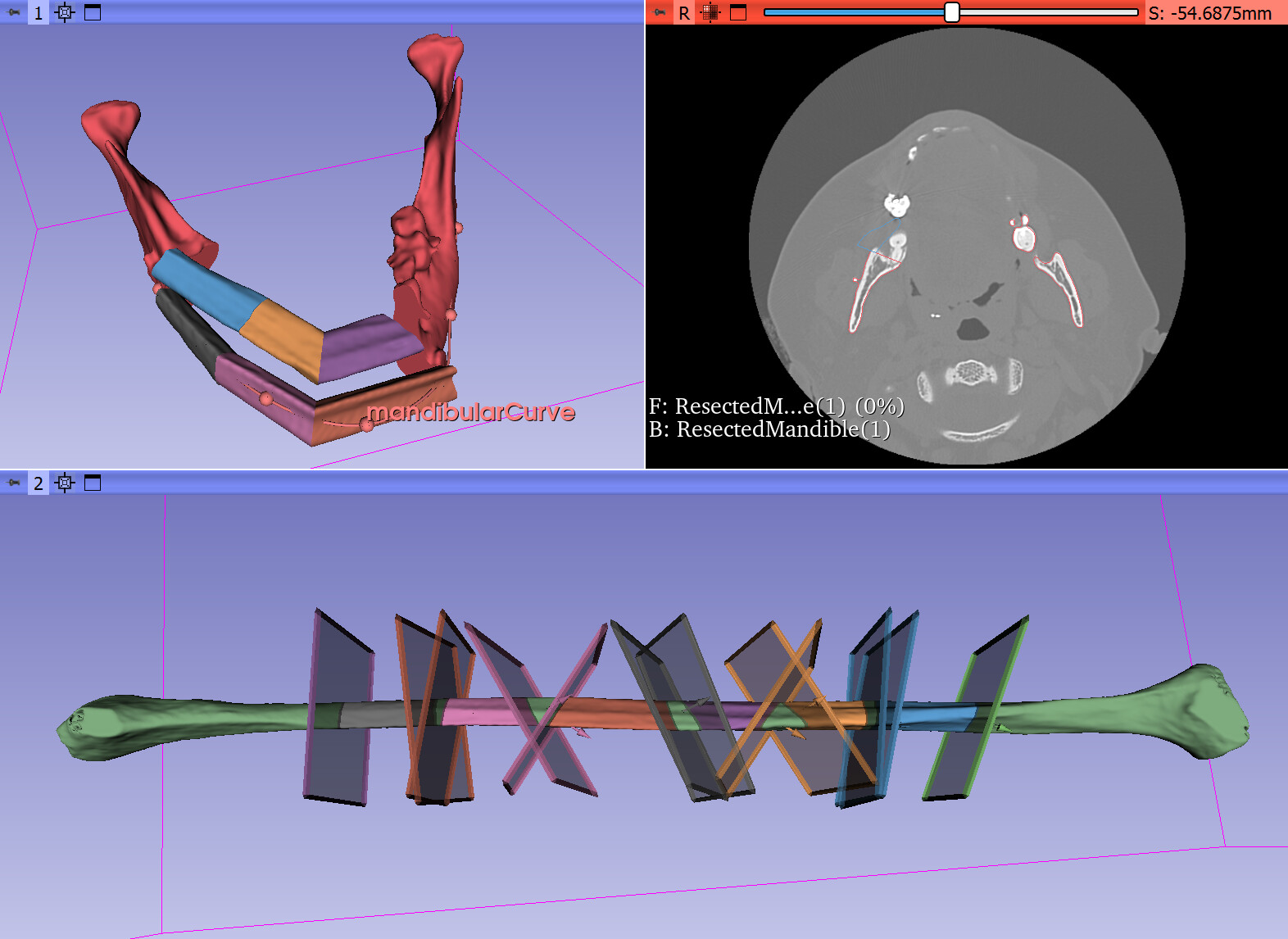 Allow maxillary reconstruction with fibula on a new module · Issue #77 ...
