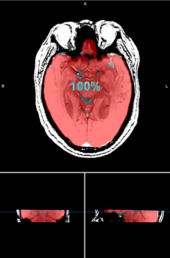 orientation change after synthstrip · Issue #1025 · freesurfer ...