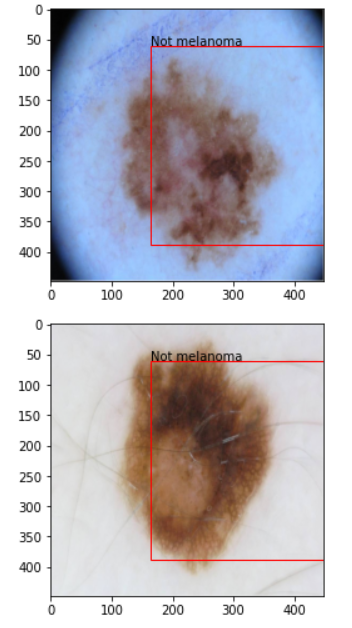 GitHub - Aizhan1202/YOLO-ISIC-melanoma-detection: Detecting melanoma on ISIC dataset using YOLO ...