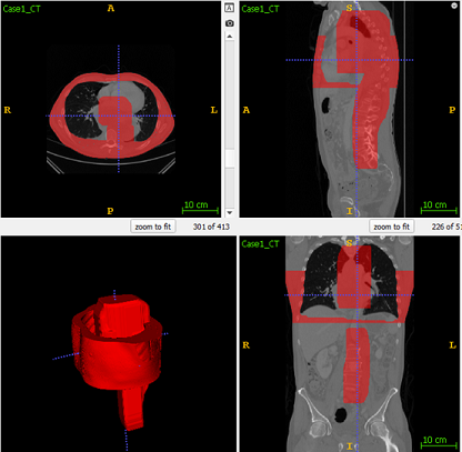 GitHub - israelwei/Spine-Segmentation: Region growing for automatic ...