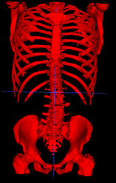 GitHub - israelwei/Spine-Segmentation: Region growing for automatic ...