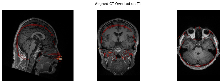 T1 and CT do not fuse well after ACPC alignment · Issue #10011 · mne ...