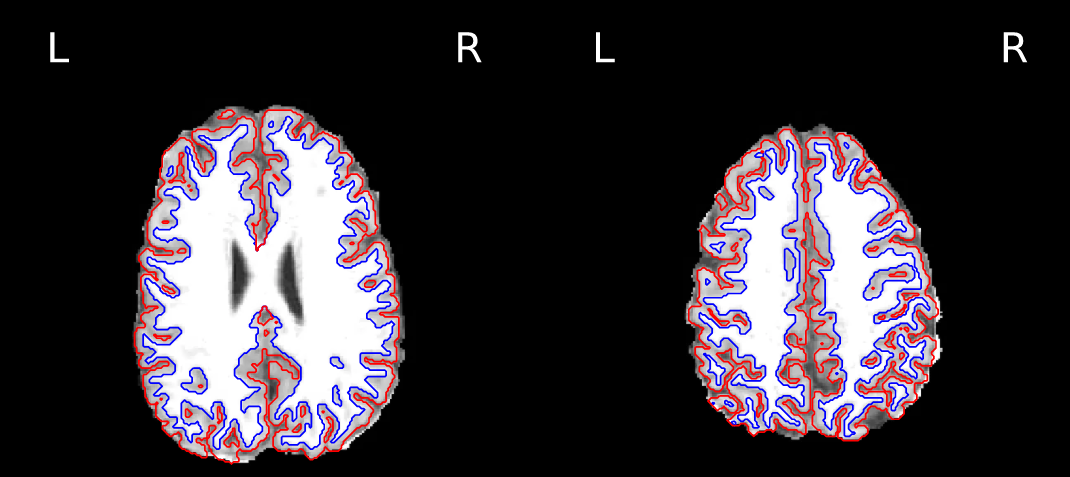 Refine ANTs brain mask with FreeSurfer · Issue #231 · nipreps/smriprep ...