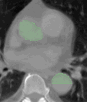 Segmentations getting arbitrary cutoffs · Issue #220 · wasserth/TotalSegmentator · GitHub