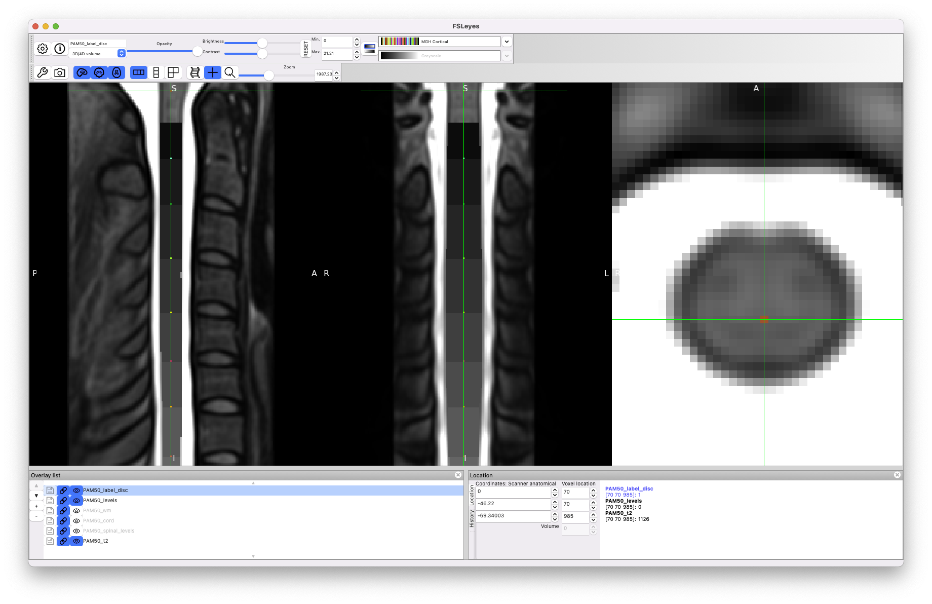 Extend C1 vertebrae on the `PAM50_levels` template file · Issue #20 · spinalcordtoolbox/PAM50 ...