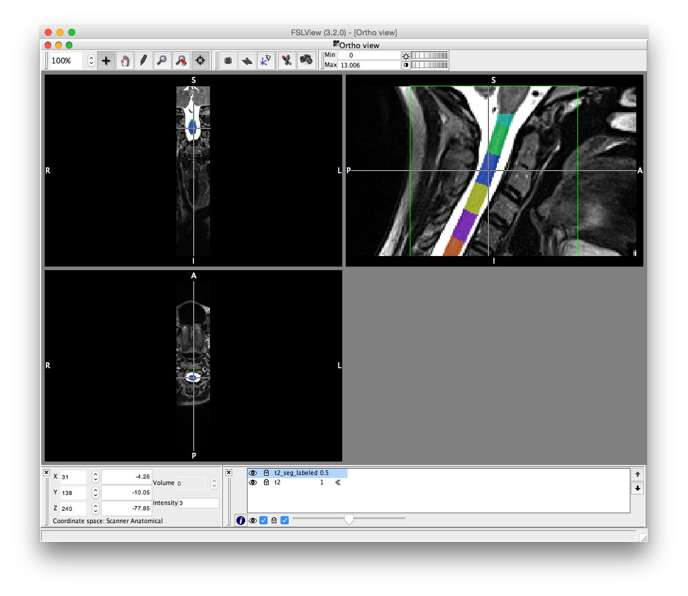 Vertebral level is off by one level when using -initc2 · Issue #1570 · spinalcordtoolbox ...