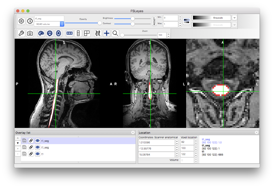 Quasi-systematic under-segmentation with sct_deepseg_sc · Issue #1716 · spinalcordtoolbox ...