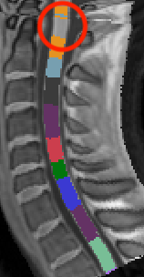 Missing chuck of the labeled segmentation from the warped label ...