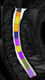 Missing chuck of the labeled segmentation from the warped label ...