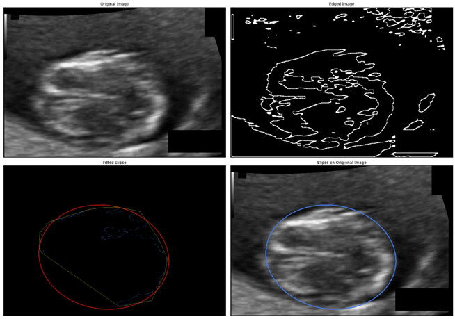 GitHub - CTGlodek/Image-Processing-fetal-head-circumference: Image ...