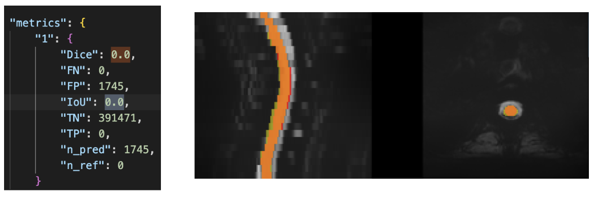 Unexpected dice score 0 for sample which has a proper prediction · Issue #1418 · MIC-DKFZ/nnUNet ...