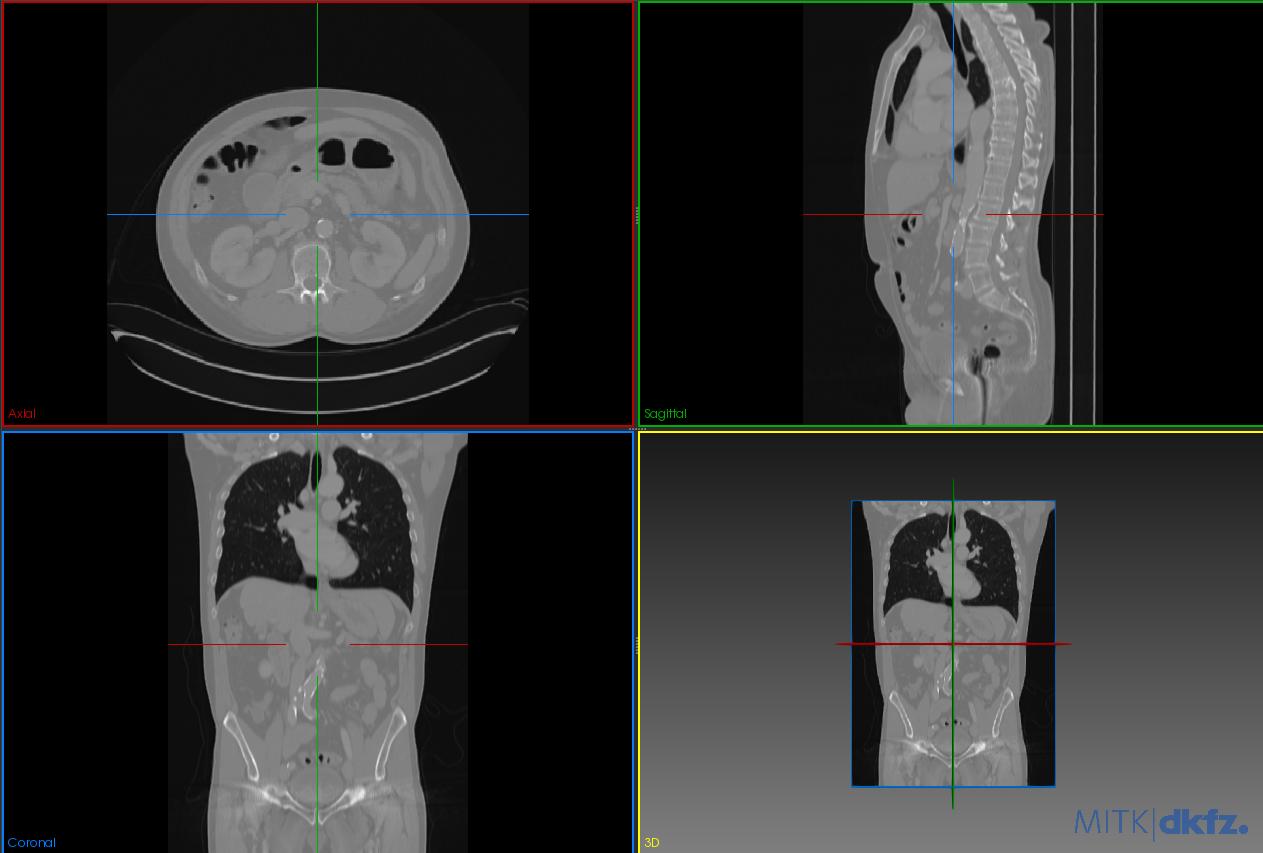 poor segmentation results · Issue #78 · wasserth/TotalSegmentator · GitHub