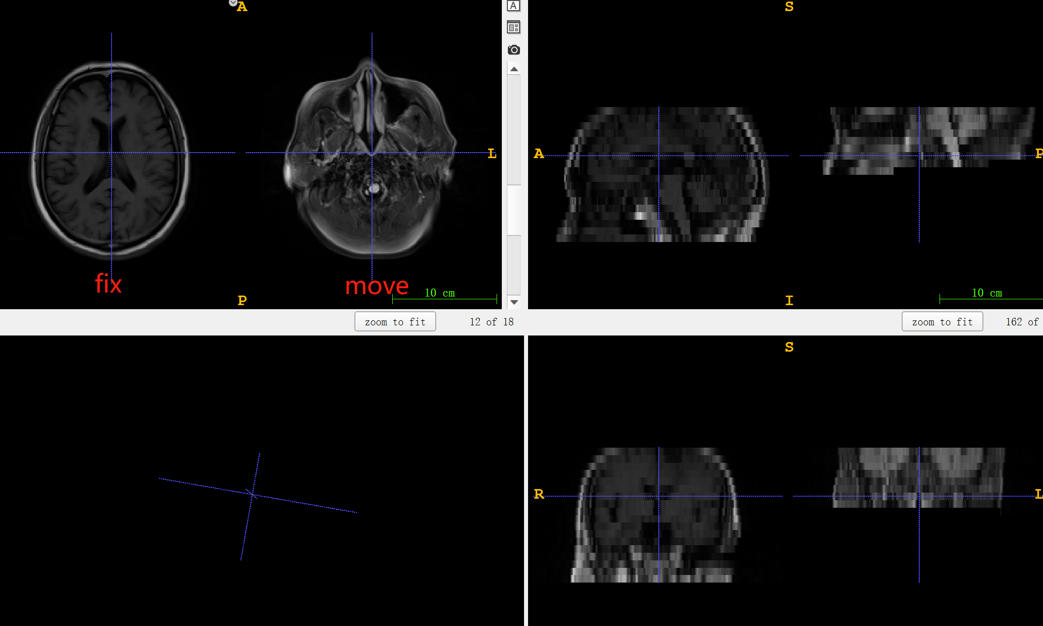 Different result when the type_of_transform is 'antsRegistrationSyNRepro[r]' and 'Affine ...