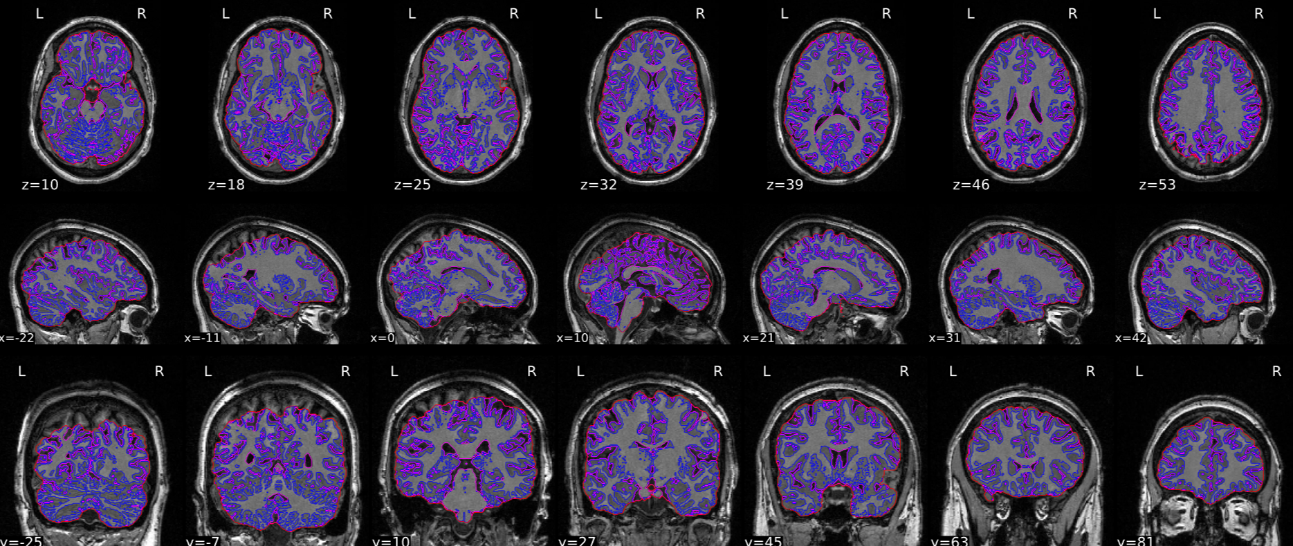 A new brain mask is still estimated while feeding skull-stripped T1w ...