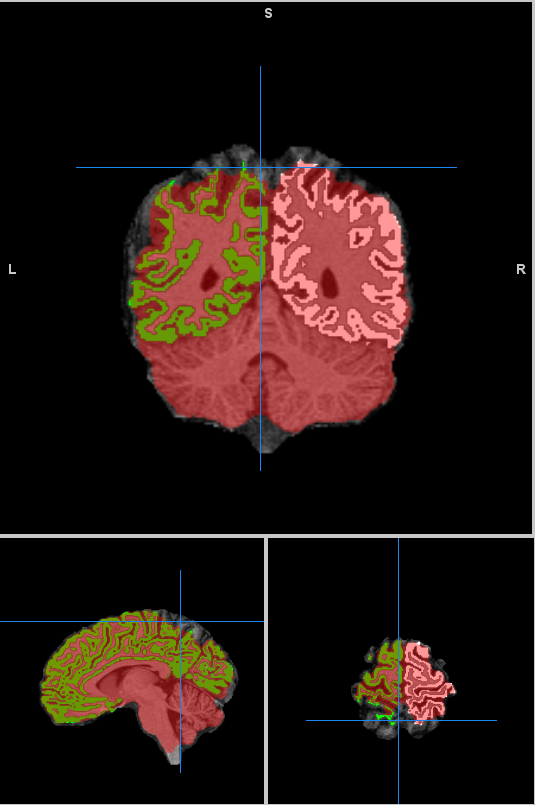 A new brain mask is still estimated while feeding skull-stripped T1w ...