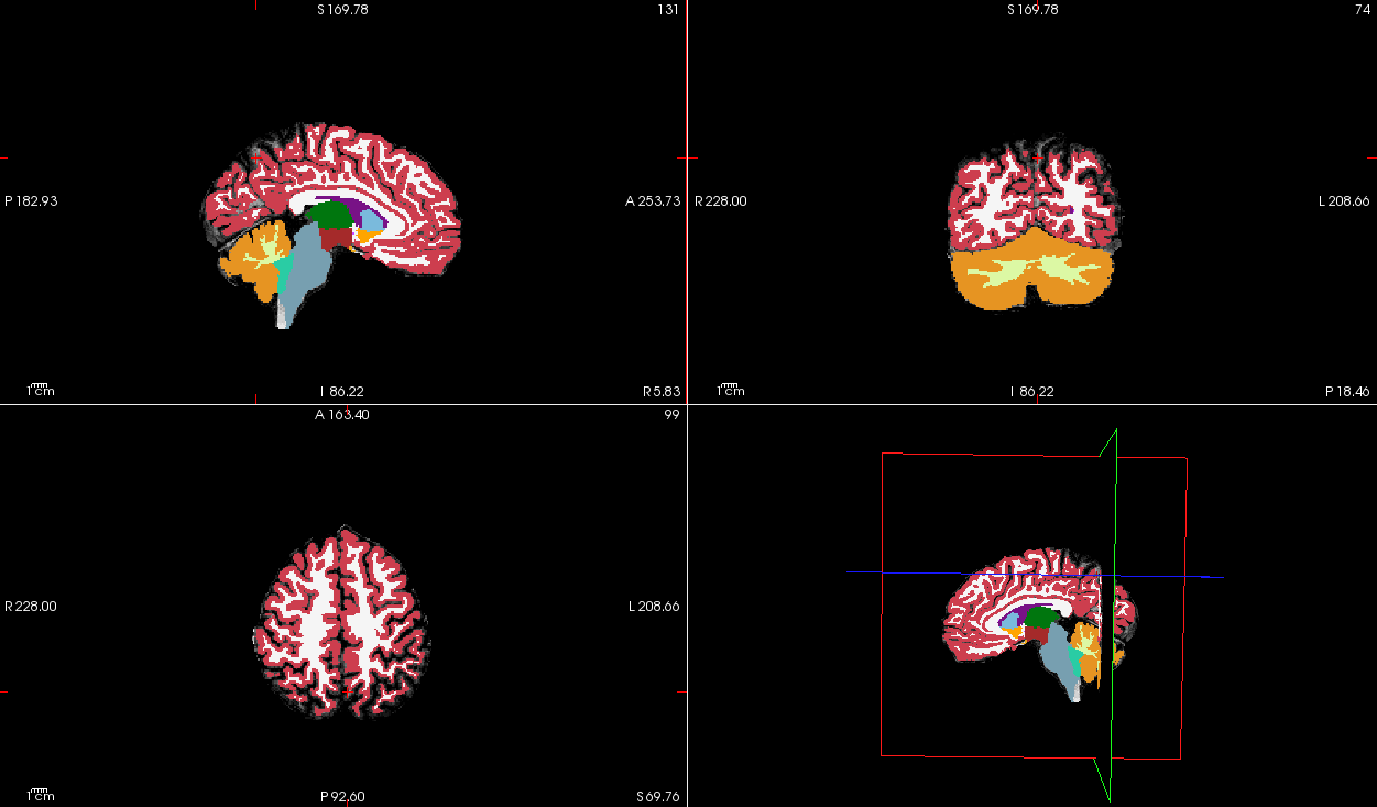 A new brain mask is still estimated while feeding skull-stripped T1w ...