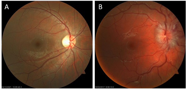 GitHub - ocaksen/papilledema