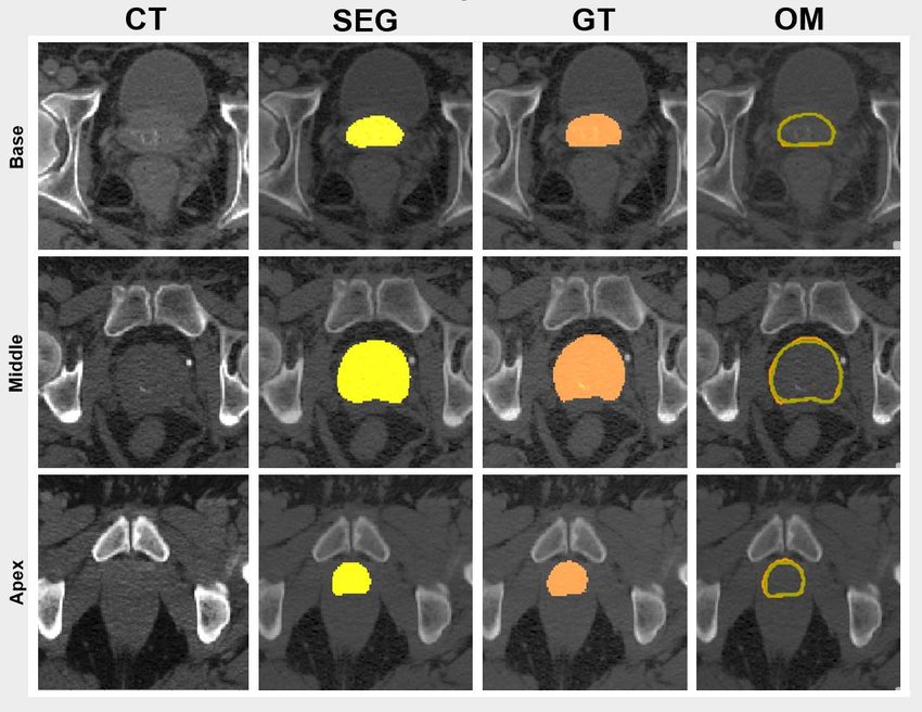GitHub - cmorris2945/Convolutional-Networks-for-Biomedical-Image-Segmentation: This is a CNN ...
