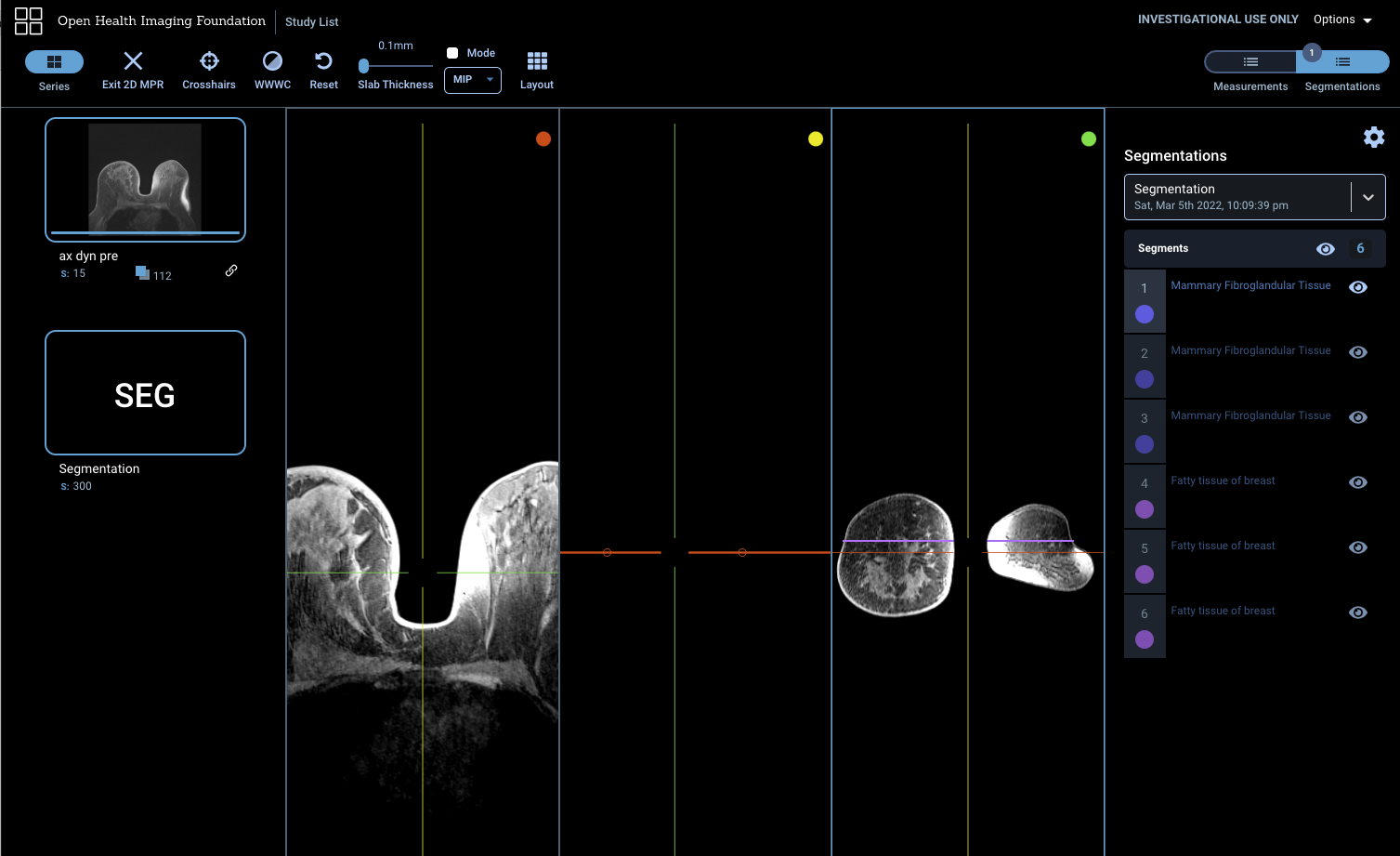 Incorrect handling of single-slice segmentations · Issue #2733 · OHIF/Viewers · GitHub