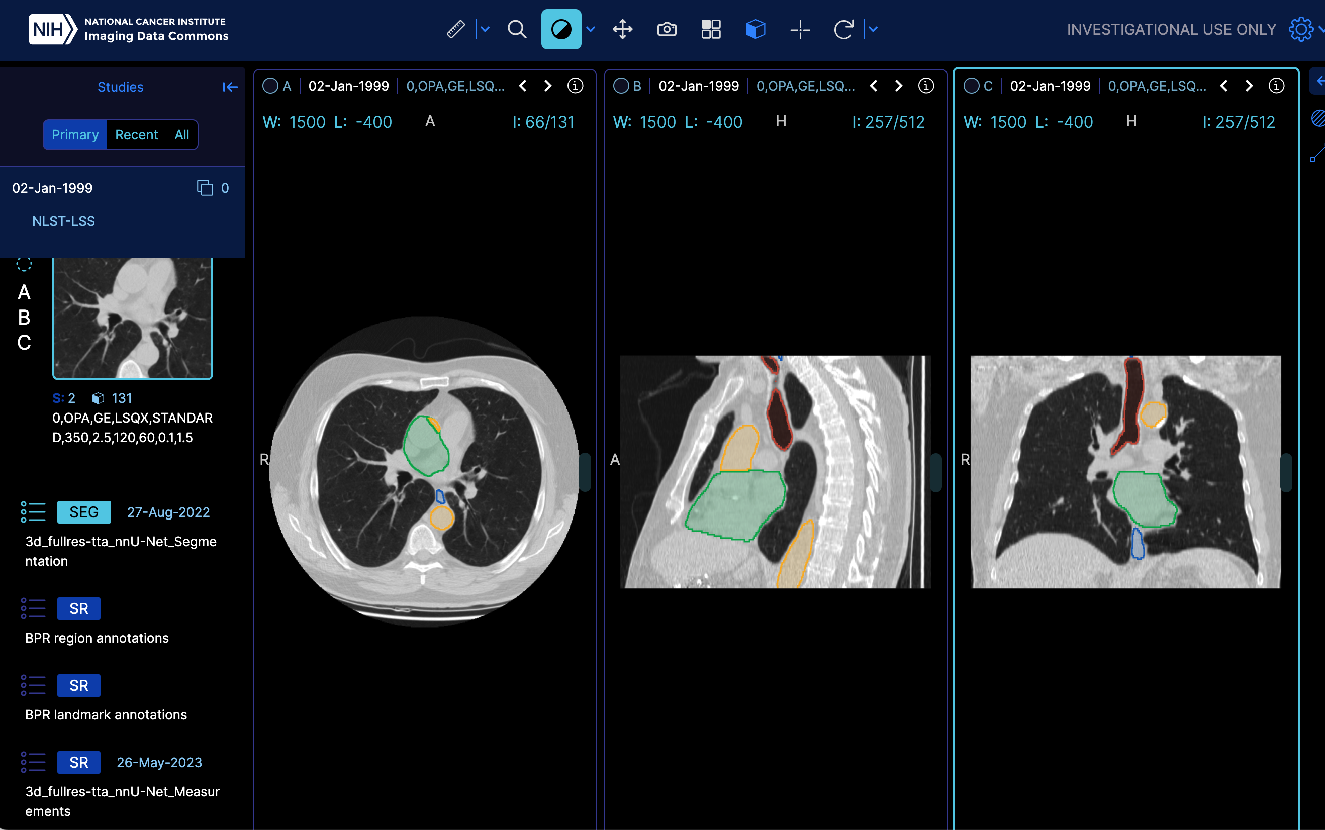 Segmentation layer add button is missing · Issue #512 · Kitware/VolView · GitHub