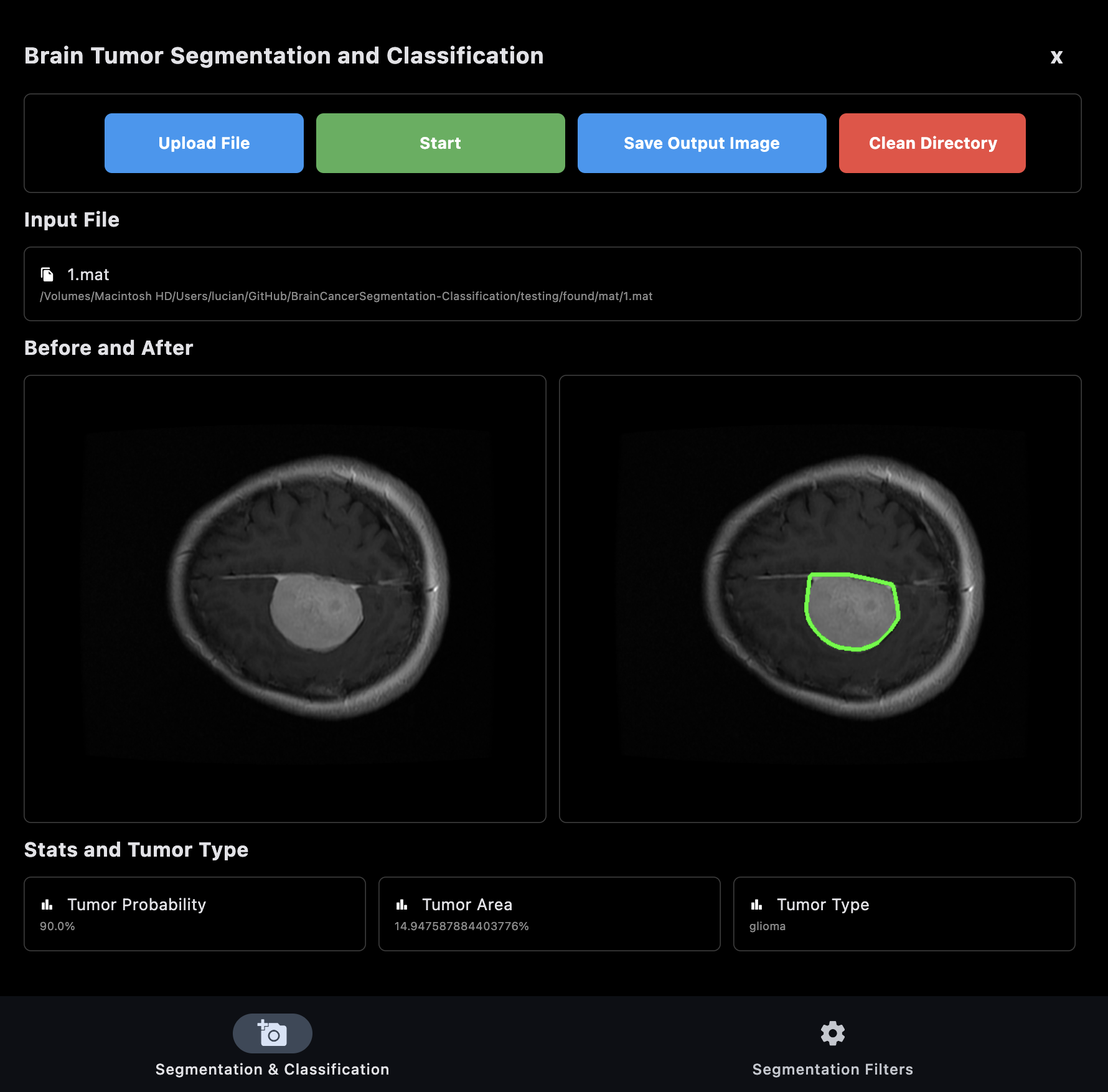 GitHub - davidebelcastro-sig/BrainCancerSegmentation-Classification: 🎓 My BSc Thesis and ...