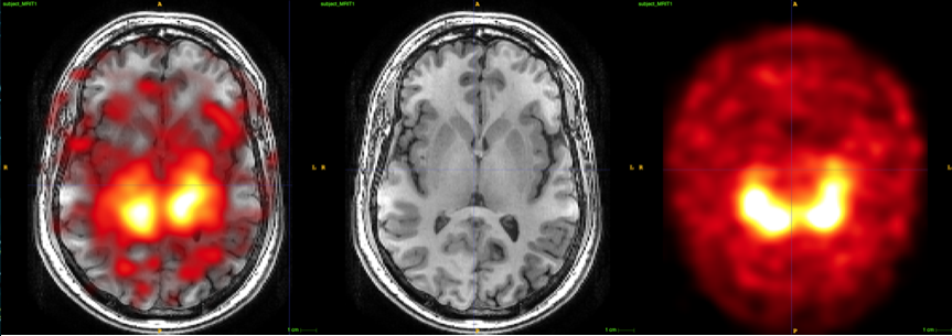 Datscan registration to MRI using ANTs · Issue #607 · ANTsX/ANTs · GitHub