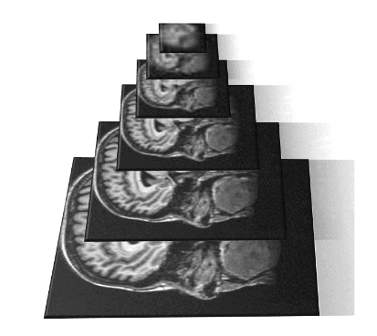 GitHub - kamruleee51/Intensity-Based-MRI-Registration: Image registration is one of the prior ...