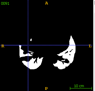 Results are of low quality · Issue #50 · mjirik/imcut · GitHub