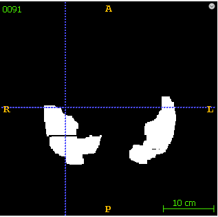 Results are of low quality · Issue #50 · mjirik/imcut · GitHub