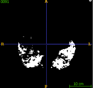Results are of low quality · Issue #50 · mjirik/imcut · GitHub