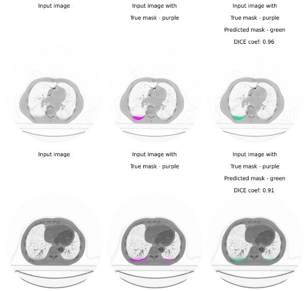 Github Ltvnsergey Pleural Effusion Detection Detect Pleural Effusion