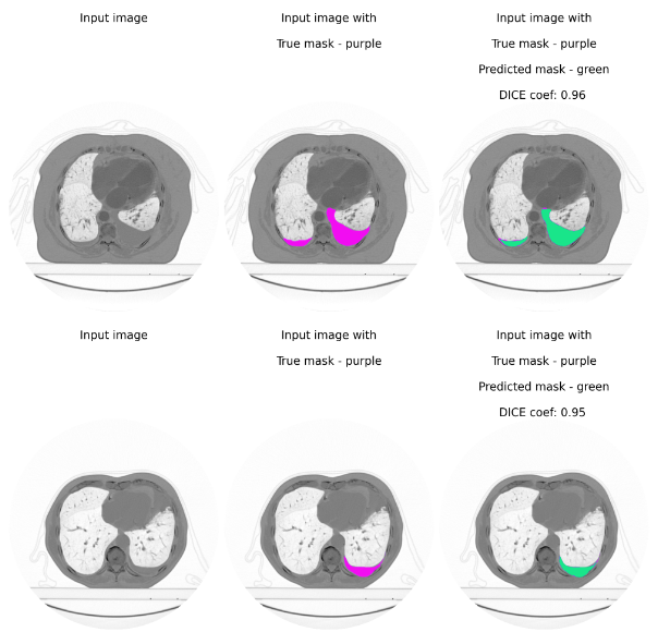 Github Ltvnsergey Pleural Effusion Detection Detect Pleural Effusion